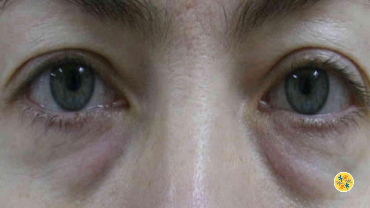 Eliminer les Cernes sous les Yeux avec 6 Méthodes