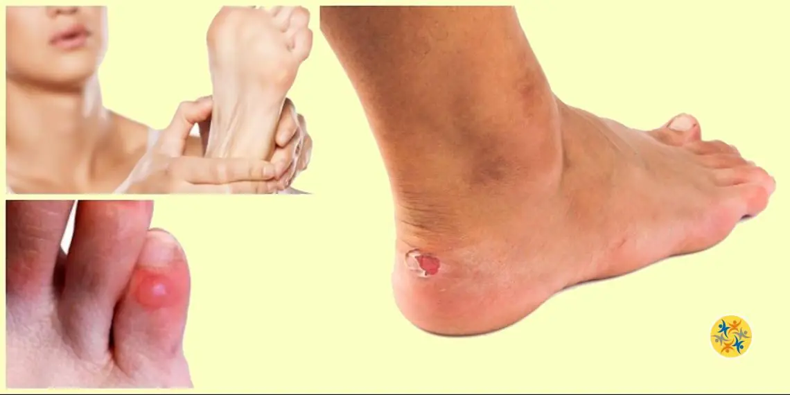 Soulager une Ampoule avec L’Astuce de Rince-bouche