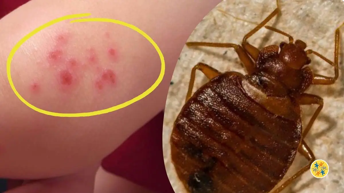 Reconnaître les Piqûres d'une Punaise de lit et les Calmer