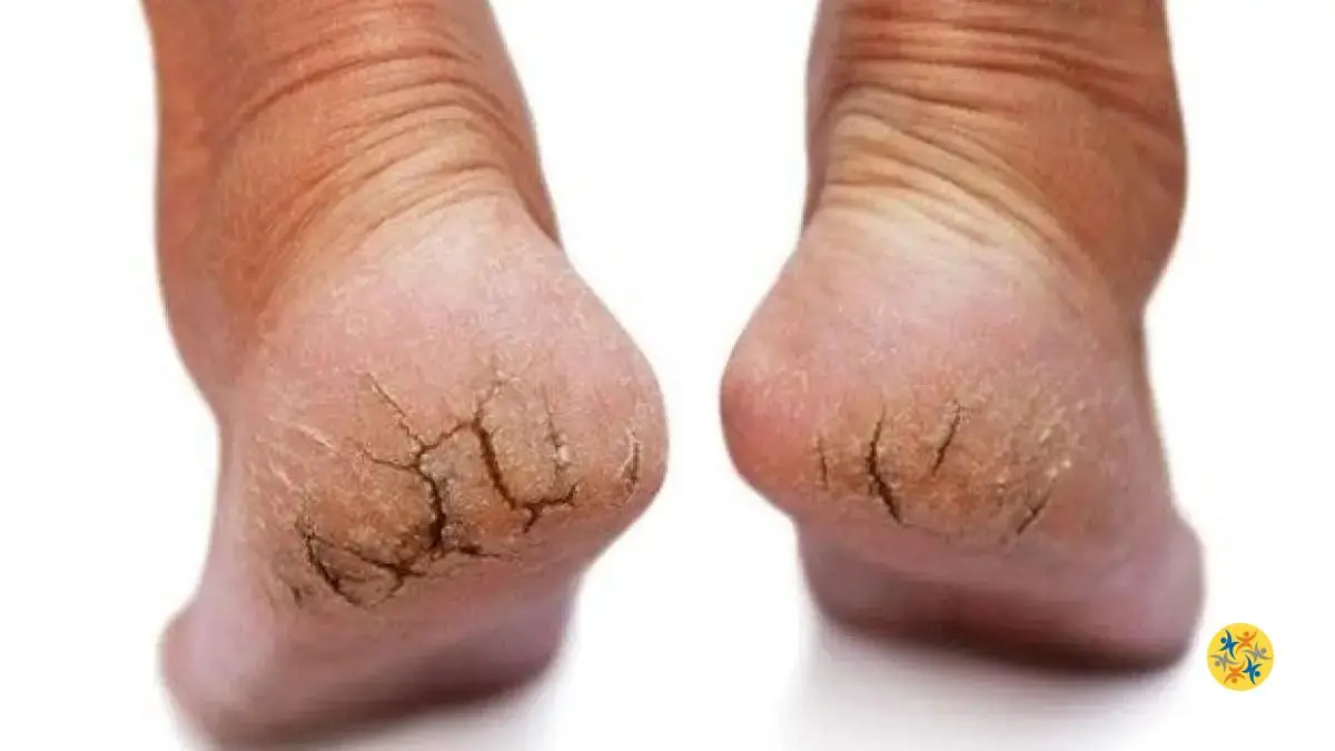 Crevasses sur les Talons: Le Remède 100 % Naturel