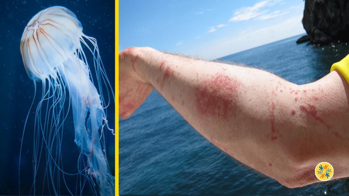 Meduse Que Faire En Cas De Piqure at Tyler Cobb blog