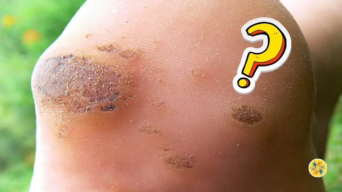 10 Remèdes Naturelles pour Éliminer les Verrues de Manière Efficace