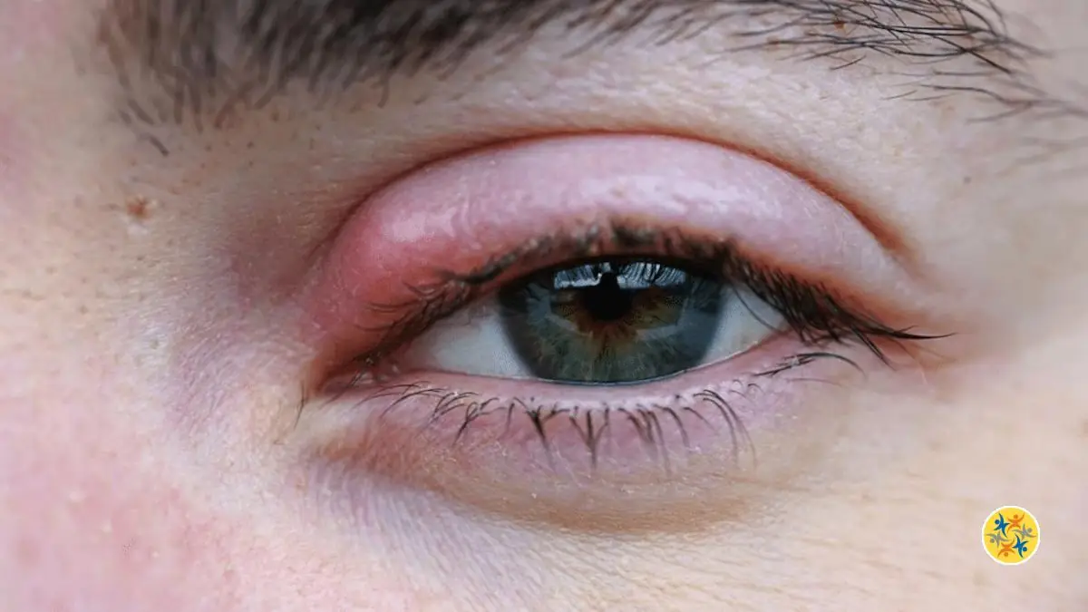 Voilà Comment Guérir l'Orgelet au Naturel et sans Médocs